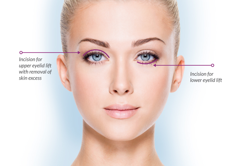Upper Eyelid Surgery Hamburg | Dr. Dalia Tobbia
